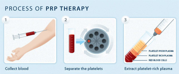 PRP Treatment - PLUSPLUS CLINIC